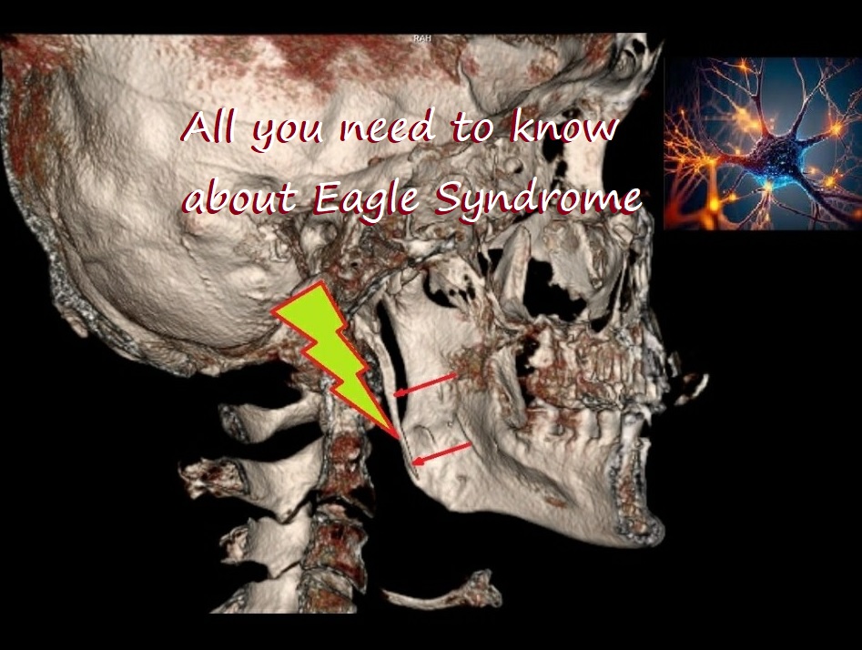 Eagle Syndrome - Symptoms, Causes, Diagnosis, Treatment, Doctors, Prognosis