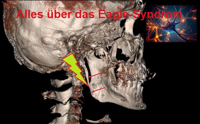 Eagle-Syndrom: Symptome, Ursachen, Diagnose, Ärzte, Therapie
